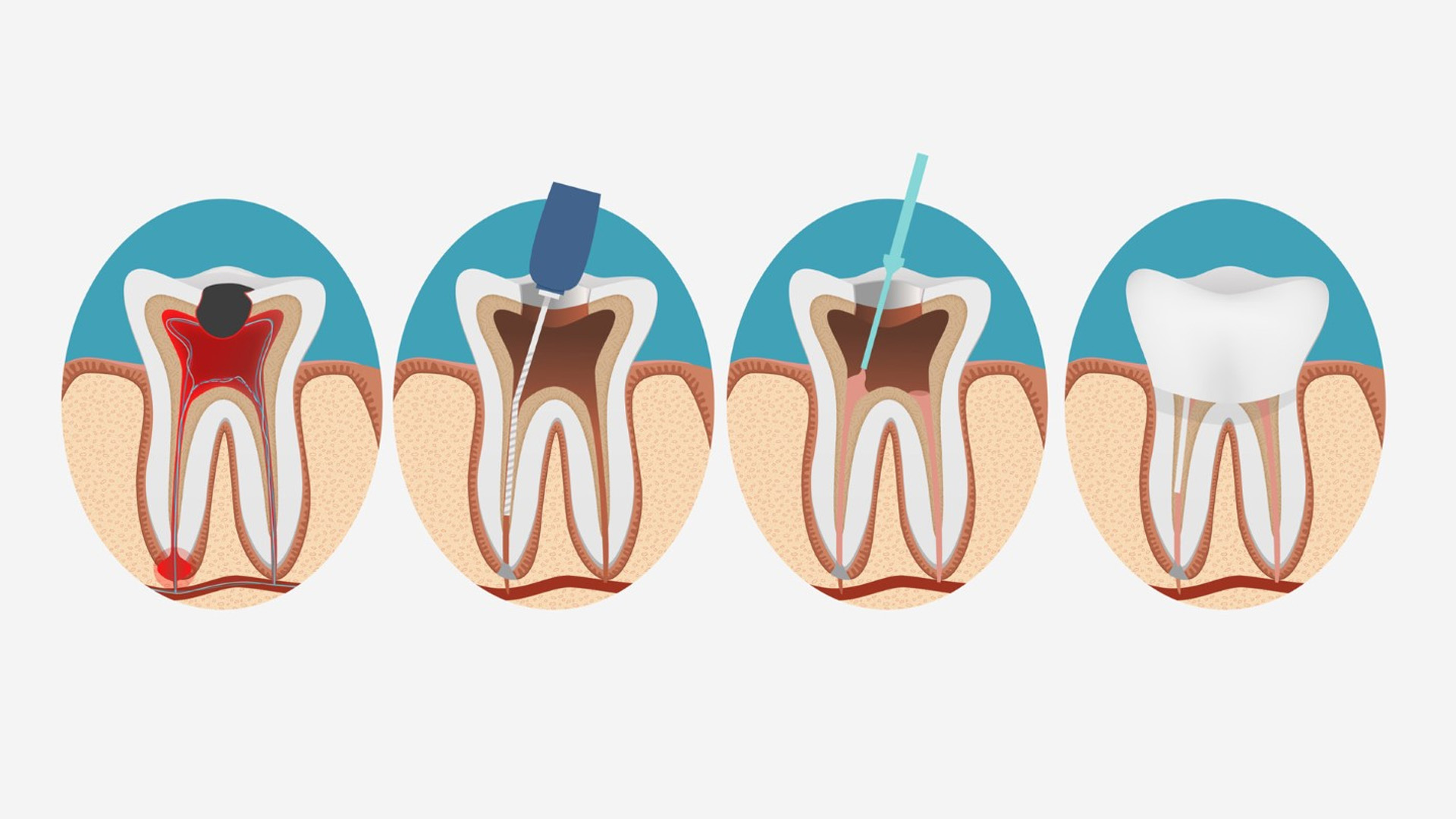 What Is Root Canal Retreatment? - Endodontic Retreatment - Liv Endodontics